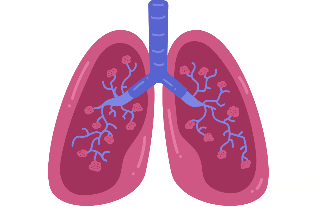 UCLH lung cancer patient receives novel vaccine in trial